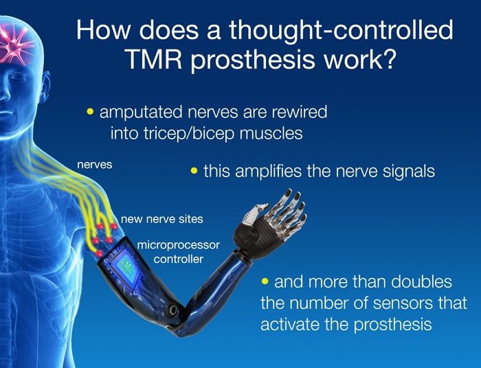 Prosthetic Technology | Arm Dynamics