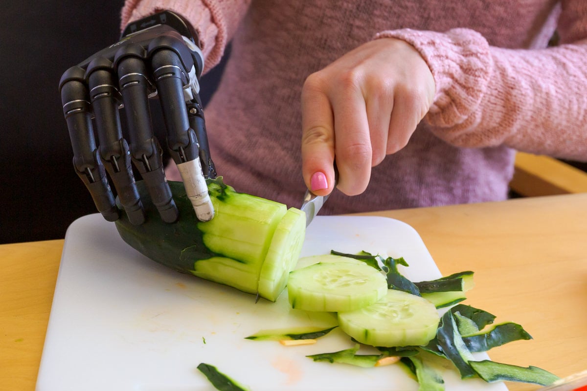 Driving After Upper Limb Loss