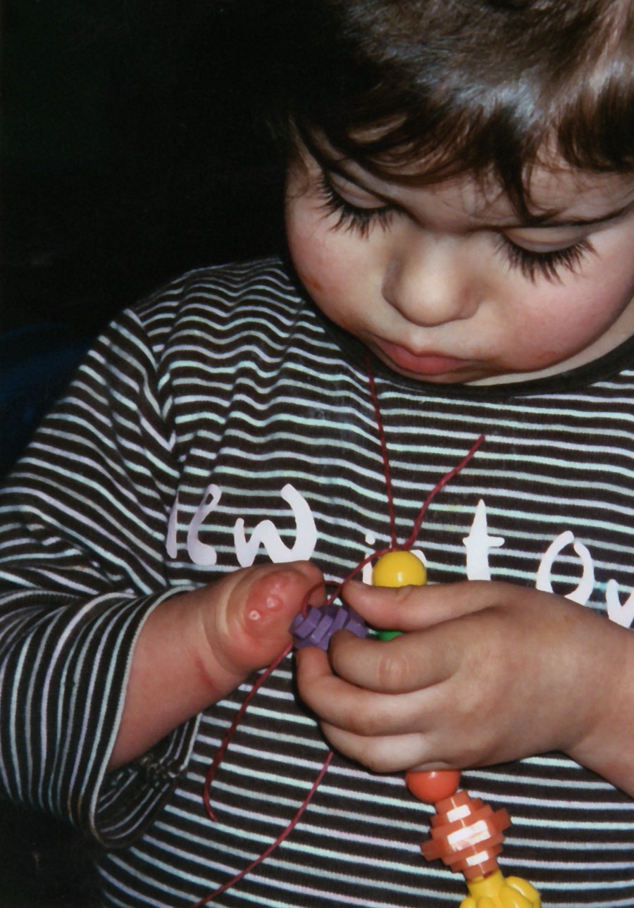 Congenital Limb Differences: What to Know Before Your Child is Born