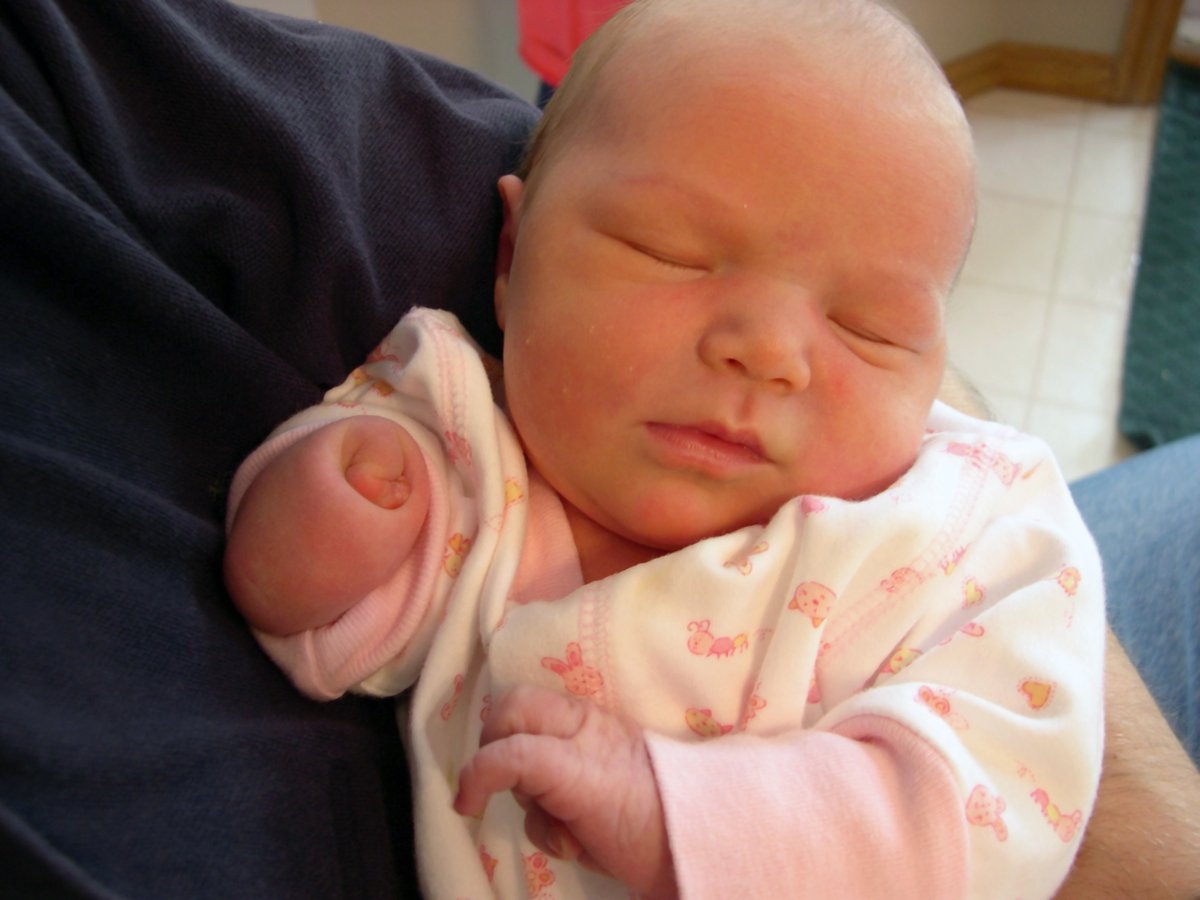 Congenital Limb Differences: What to Know Before Your Child is Born