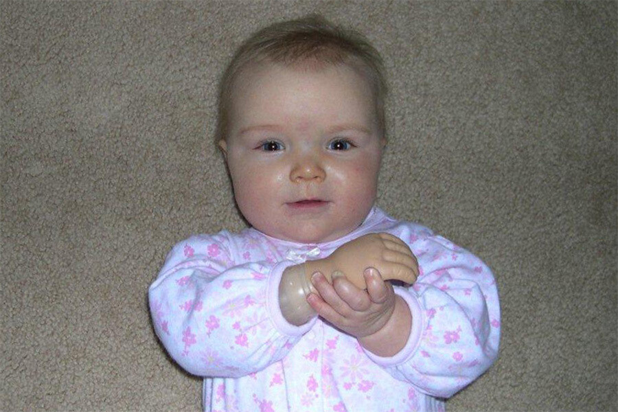 Upper Limb Prosthetics for Children