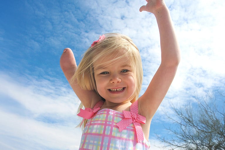 Upper Limb Prosthetics for Children