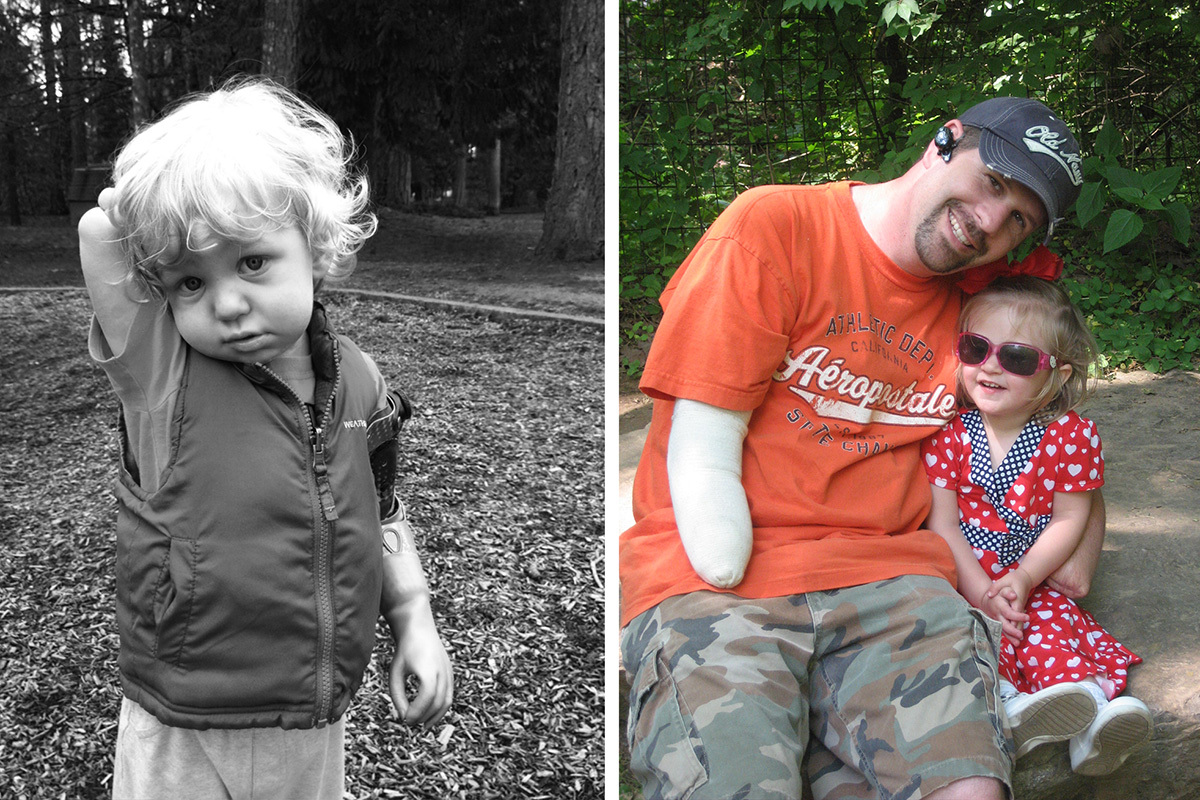 Donning and Doffing Your Upper Limb Prosthesis