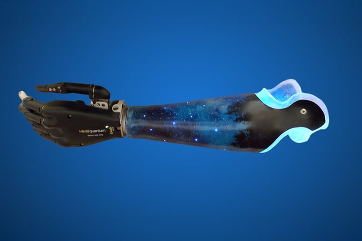 Prosthetic Care for Upper Limb Fireworks-Related Injuries