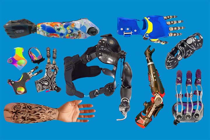 How Are Prosthetic Arms, Hands and Partial Hands Fitted?
