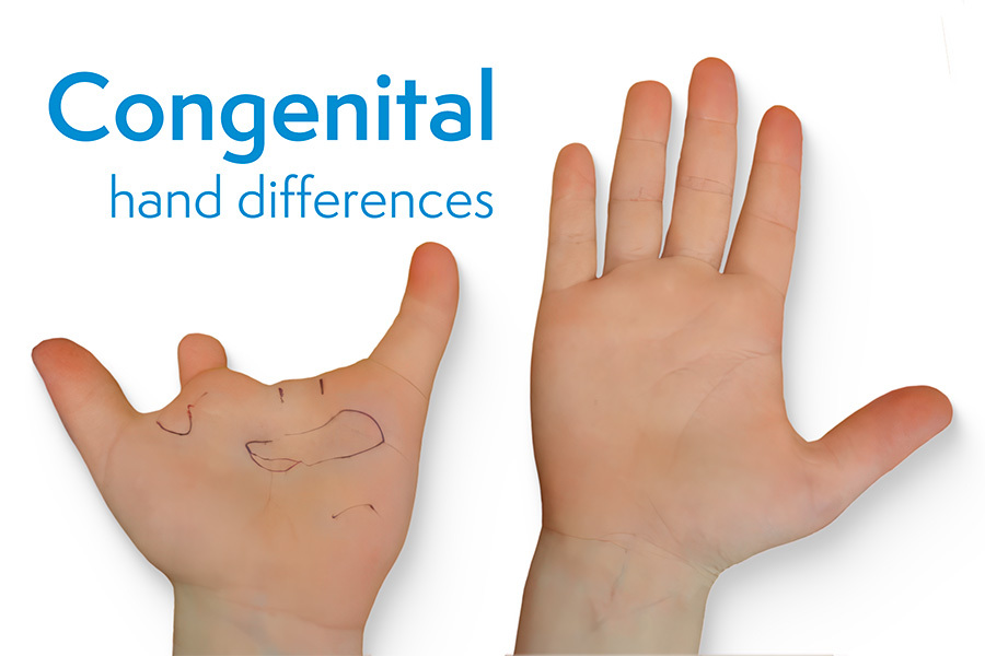 Prosthetic Options for Congenital Hand Differences in Children