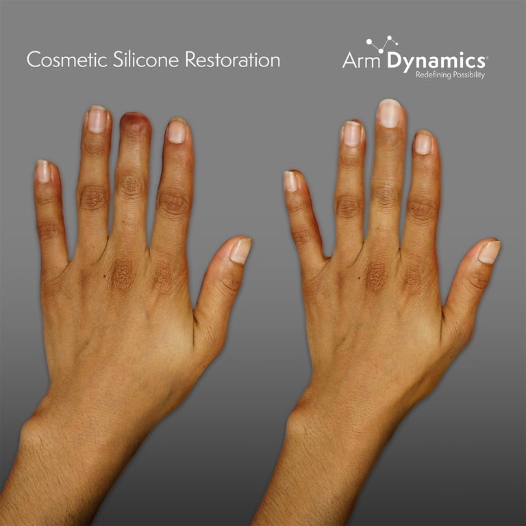 Prosthetic Options for Varying Levels of Finger/Hand Differences or Loss