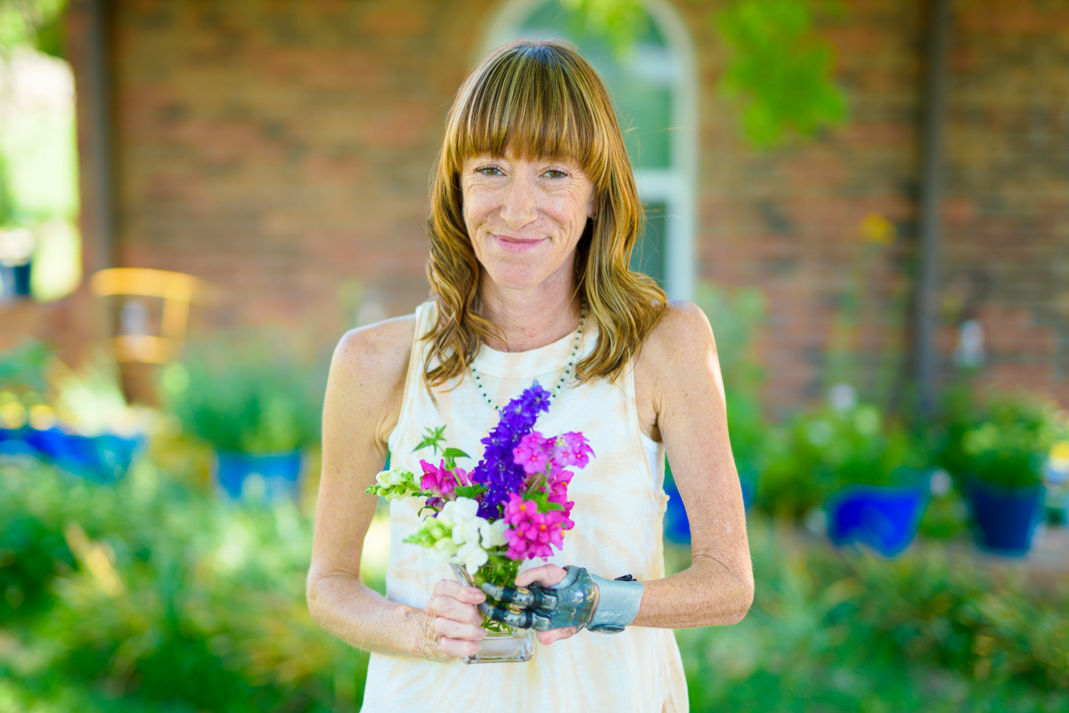 The Upper Limb Library | Congenital Limb Differences