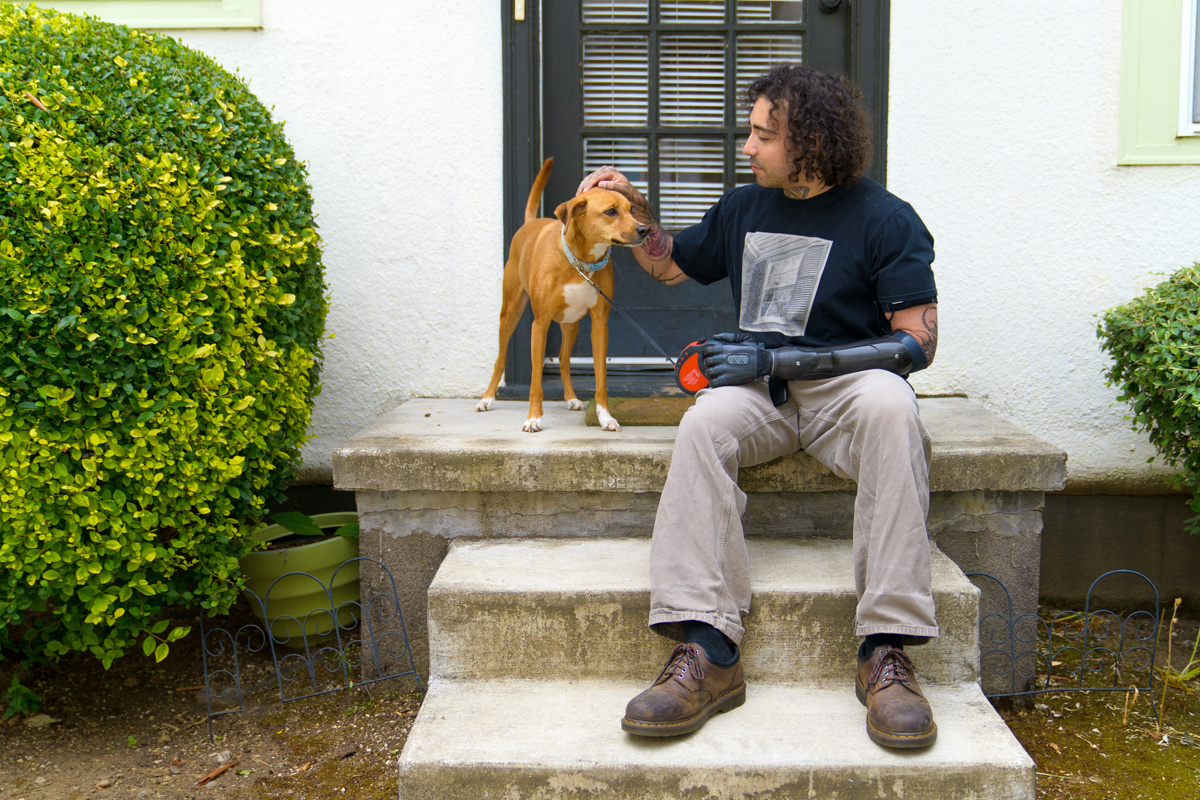 Introduction to Phantom Limb Pain and Phantom Sensations