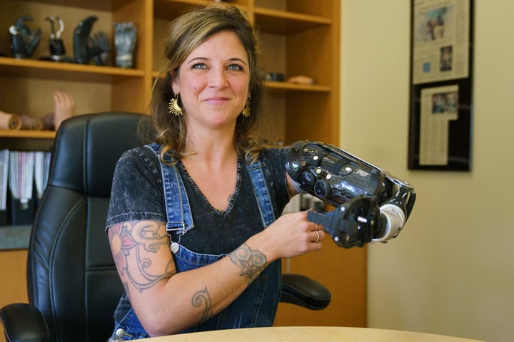 Finding Joy After an Upper Limb Amputation