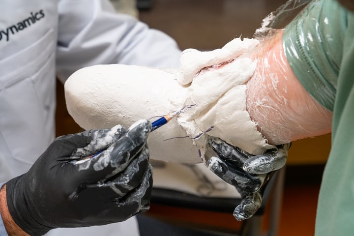 How Are Prosthetic Arms, Hands and Partial Hands Fitted?
