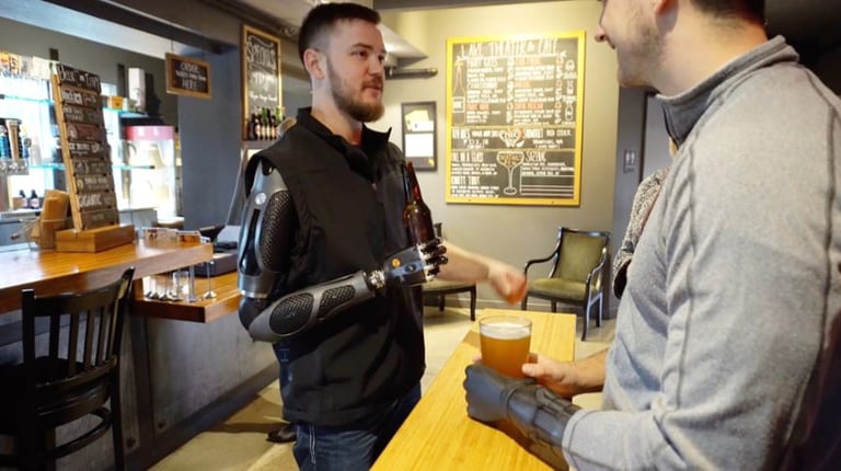 Overuse Issues for People with an Upper Limb Difference