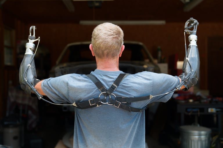 How Are Prosthetic Arms, Hands and Partial Hands Fitted?