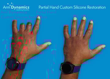 Understanding Upper Limb Prosthetic Options | Arm Dynamics