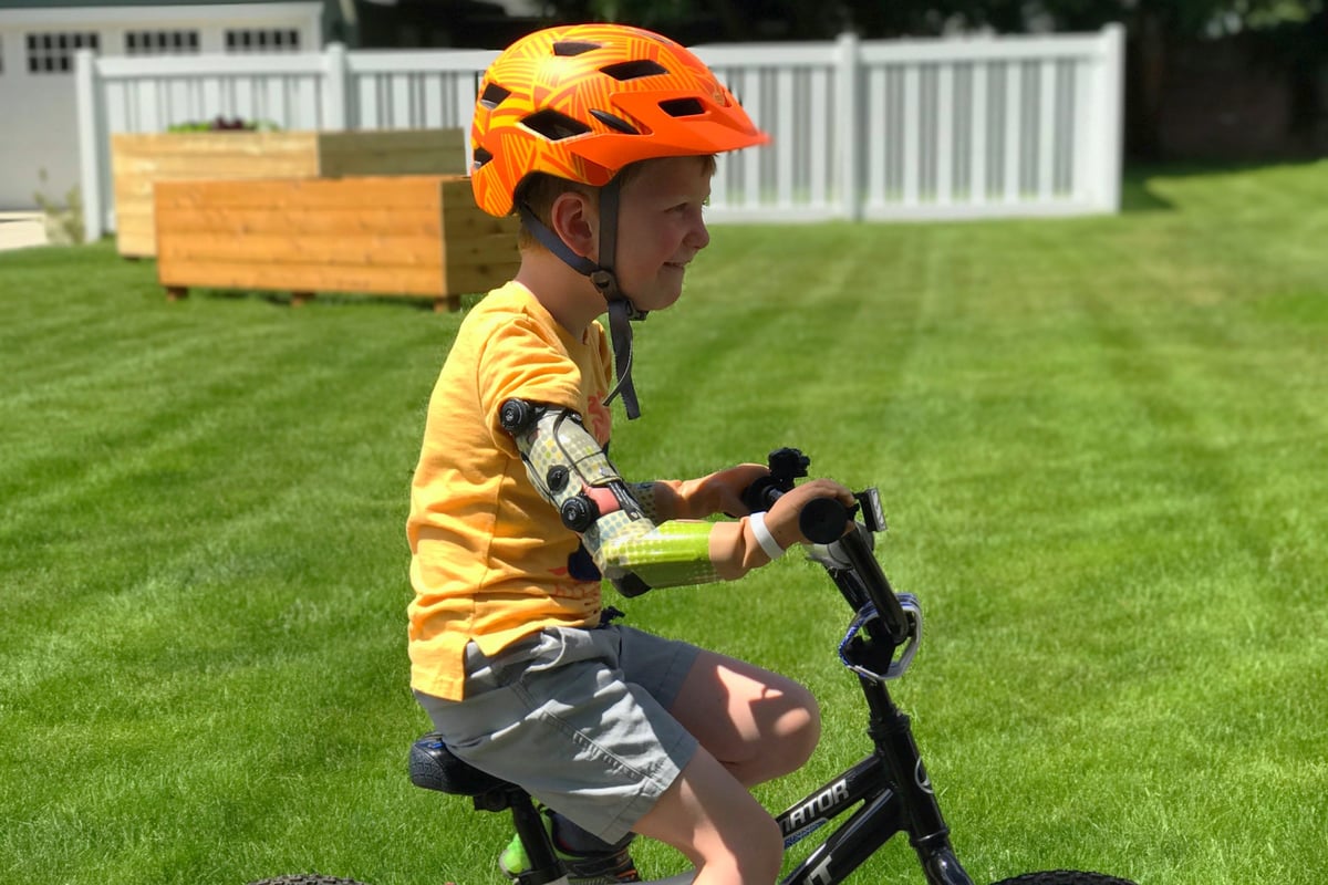 Congenital Limb Differences: What to Know Before Your Child is Born