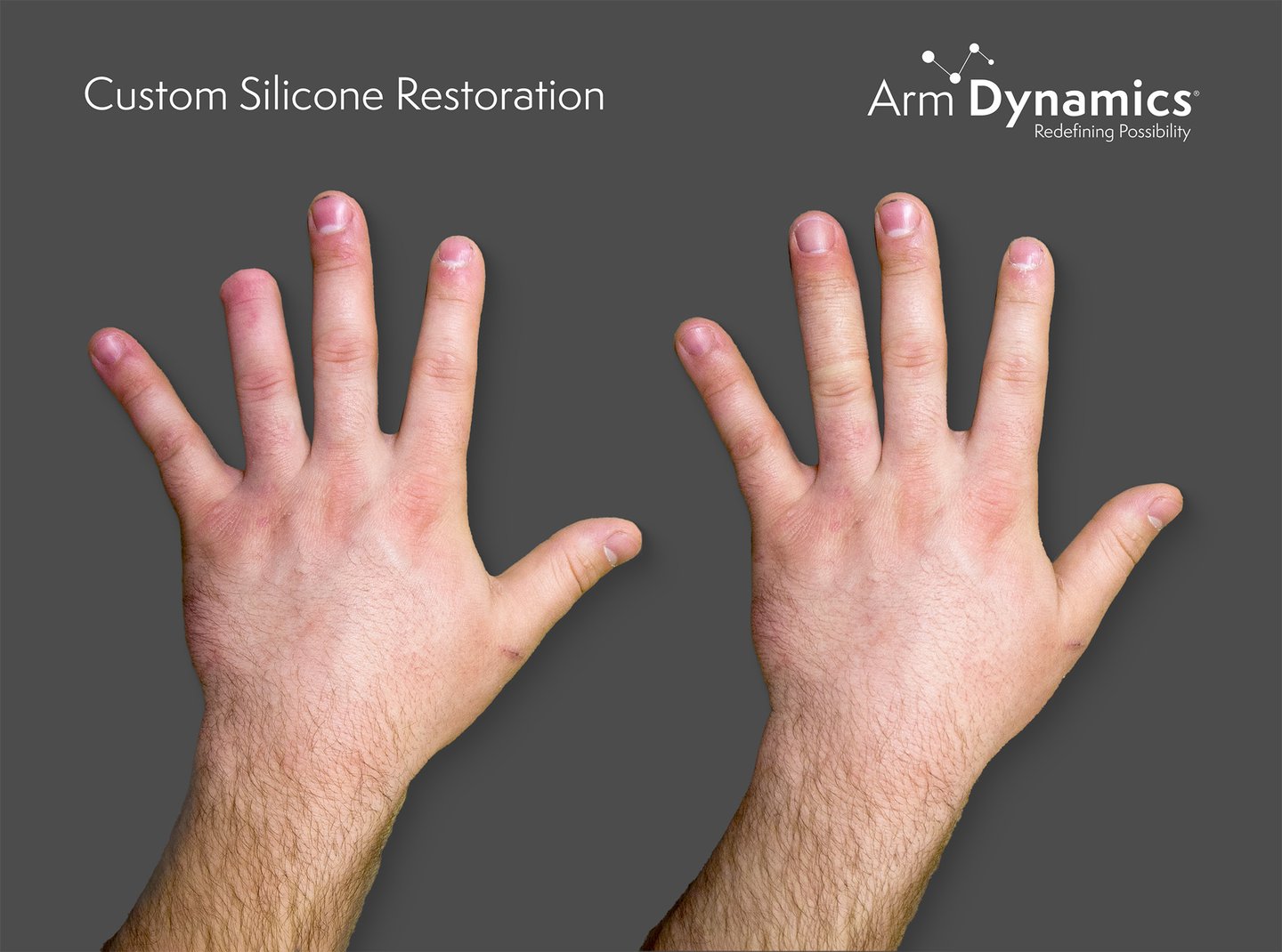 An Introduction to Passive Silicone Restorations
