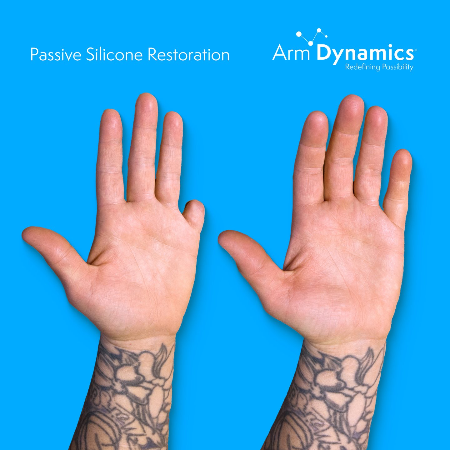 Upper Limb Prosthesis Parts