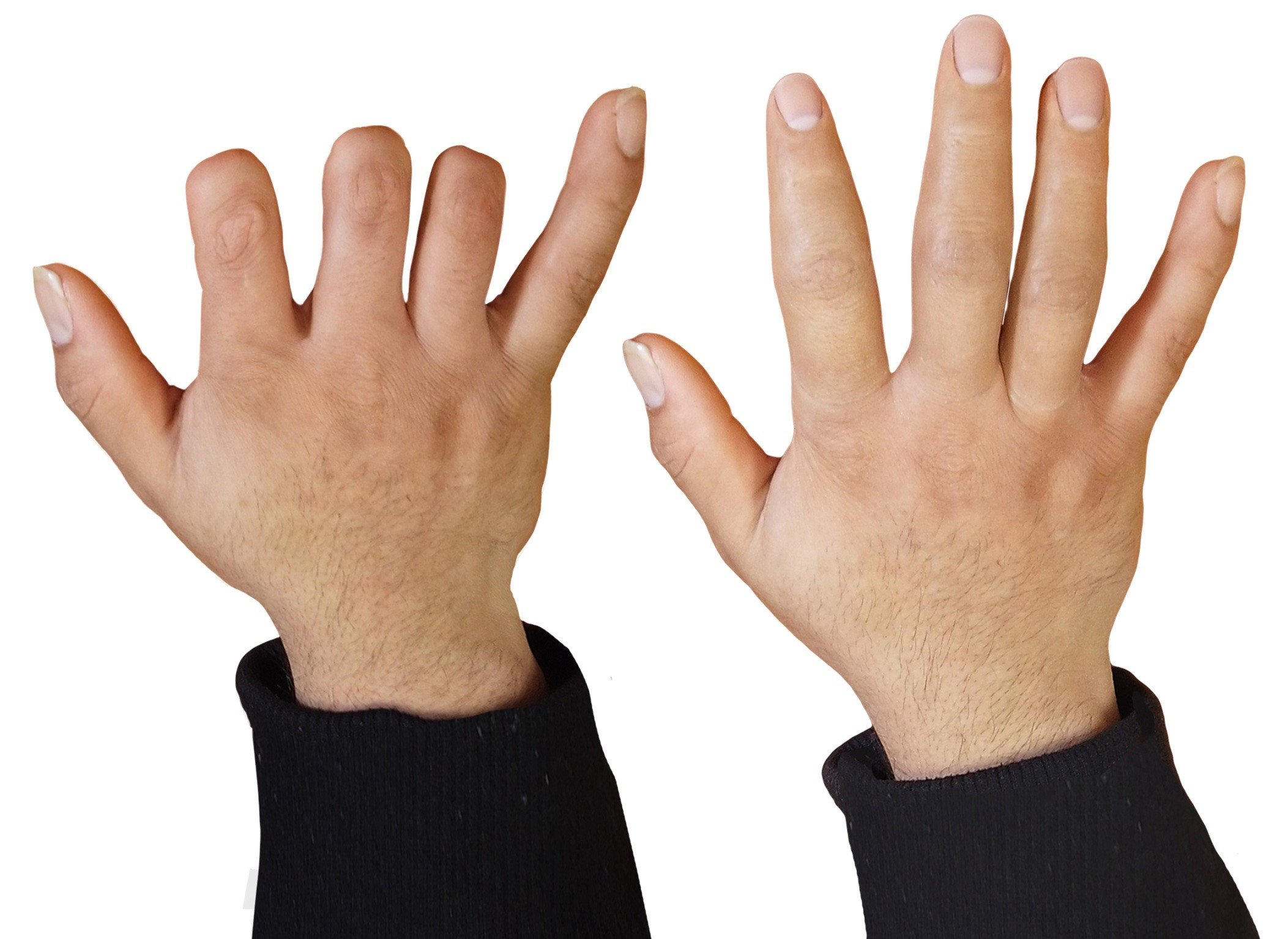 Prosthetic Options for Varying Levels of Finger/Hand Differences or Loss