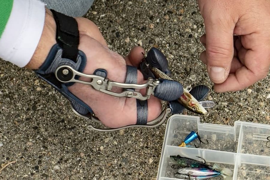 Modern, functional prosthetic solutions for finger and partial hand ...