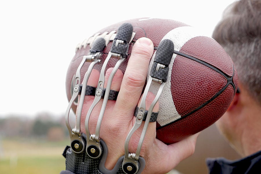 Modern, functional prosthetic solutions for finger and partial hand ...