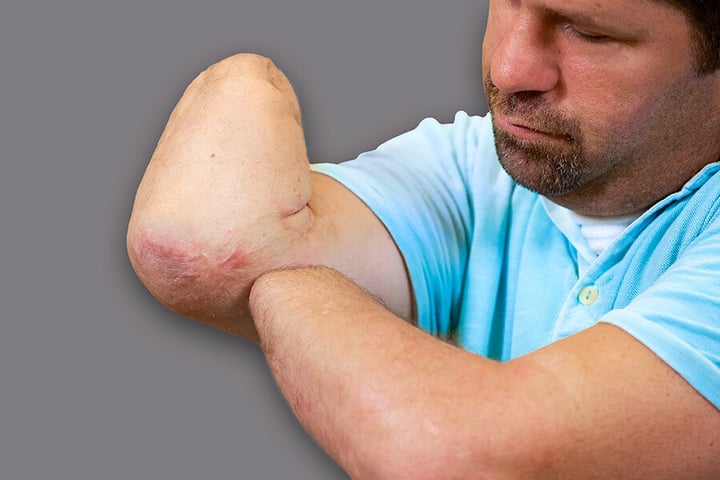 Introduction to Targeted Muscle Reinnervation (TMR)