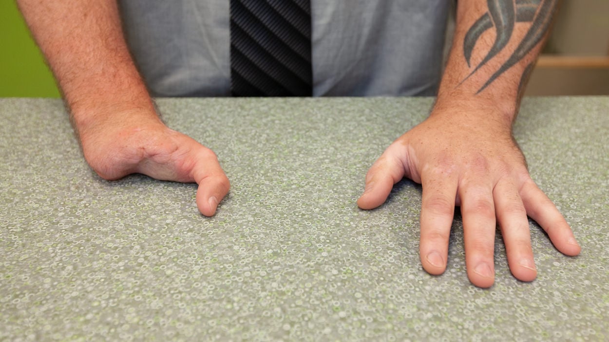 Prosthetic Options | Arm Dynamics