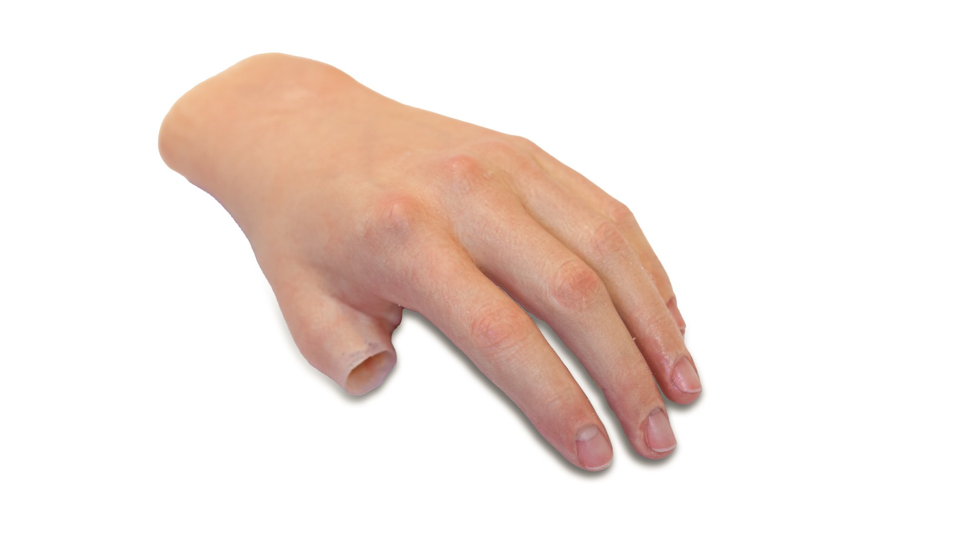 Finger and Partial Hand Prosthetic Options | Arm Dynamics