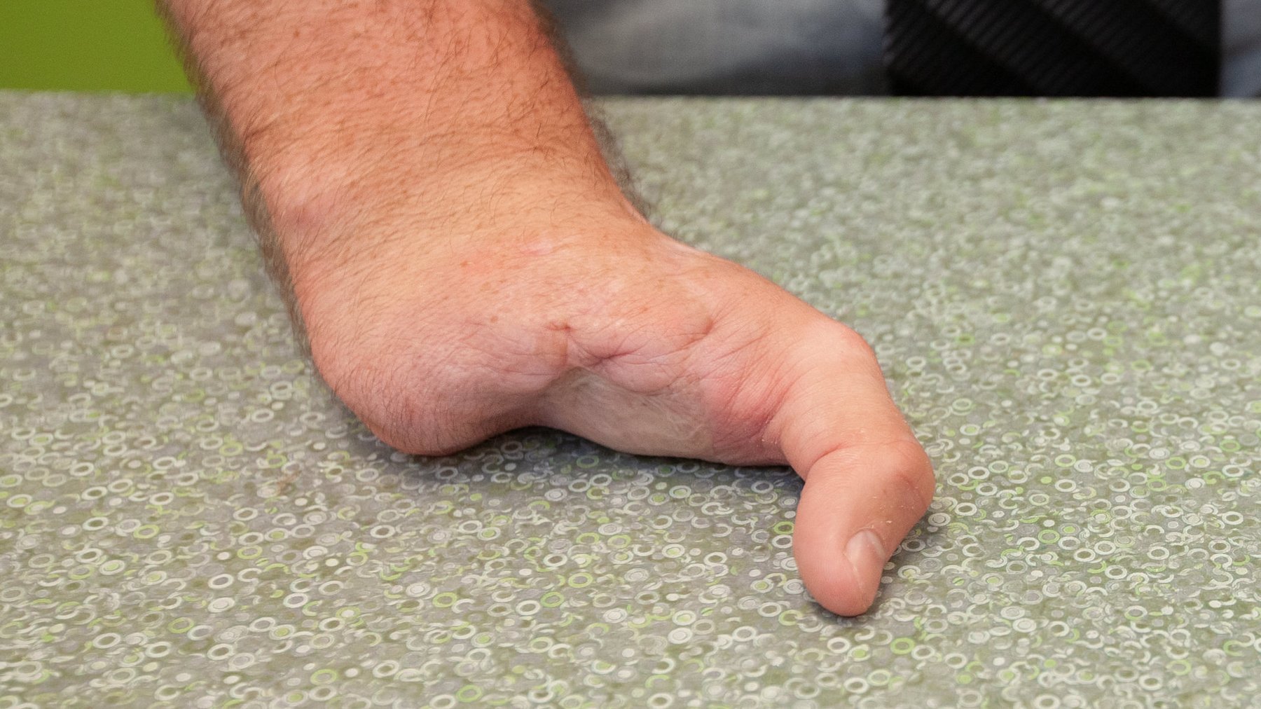 Amputation Levels | Arm Dynamics