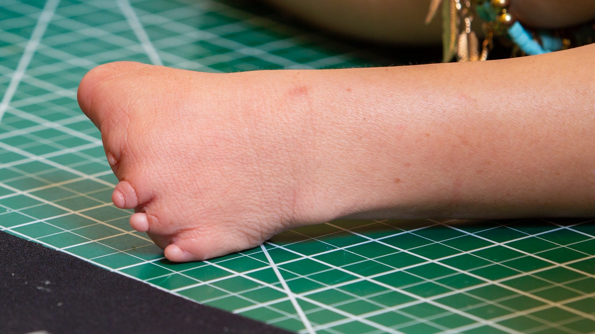 Finger and Partial Hand Prosthetic Options | Arm Dynamics