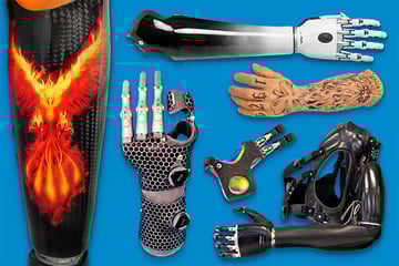 What is a Hybrid Upper Limb Prosthesis?