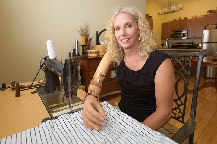 Adults with Congenital Limb Differences