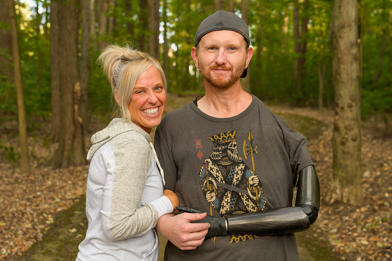 Shoulder Level Limb Differences