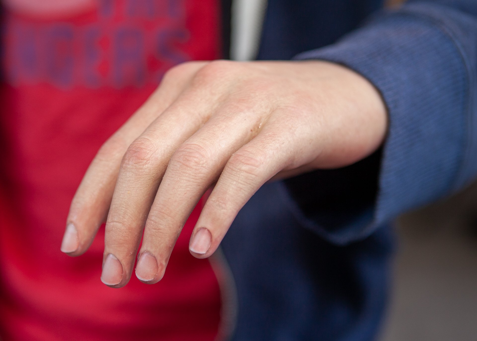 Better Choices for People with Partial Hand and Finger Loss