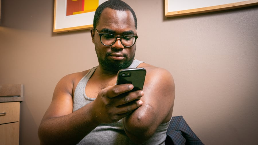 Amputation Levels | Arm Dynamics