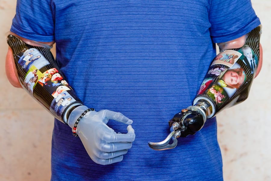 Creativity and Prosthetic Devices