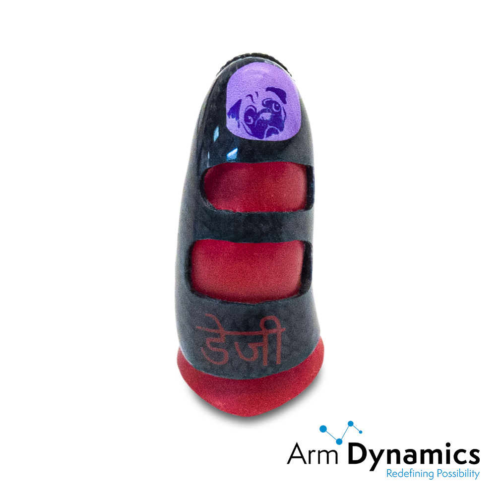 Prosthetic Options for Partial Thumb Amputations or Differences