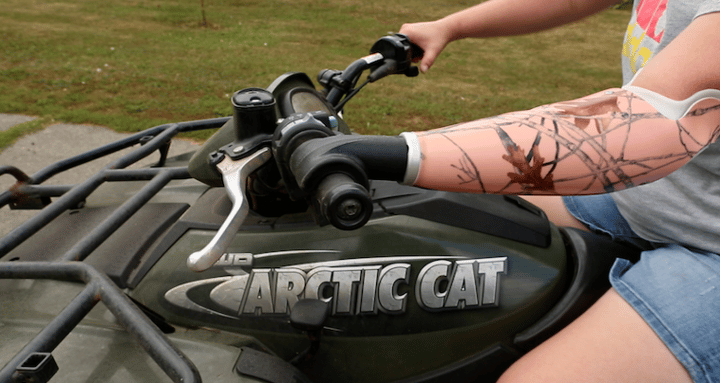 Driving After Upper Limb Loss