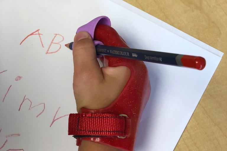 Partial Hand Limb Differences: Through the Palm