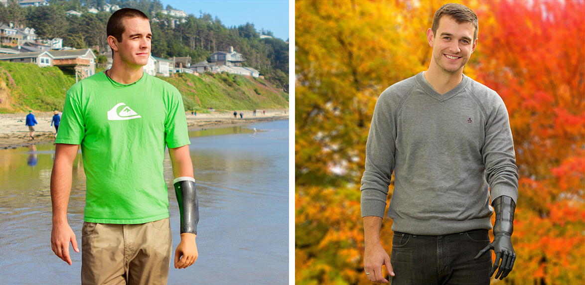 “Is Everyone Looking at Me?” Upper Limb Differences and Public Perception