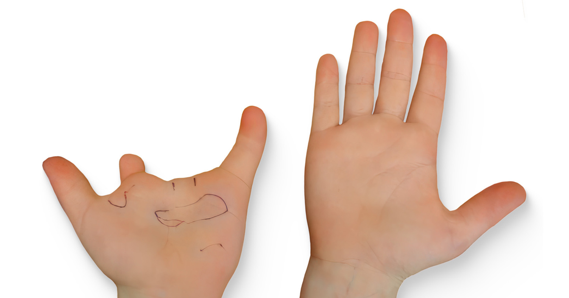 Prosthetic Options for Congenital Hand Differences in Children