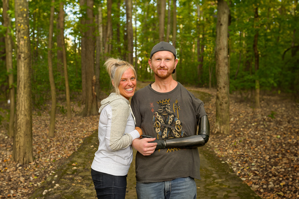 Shoulder Level Limb Differences