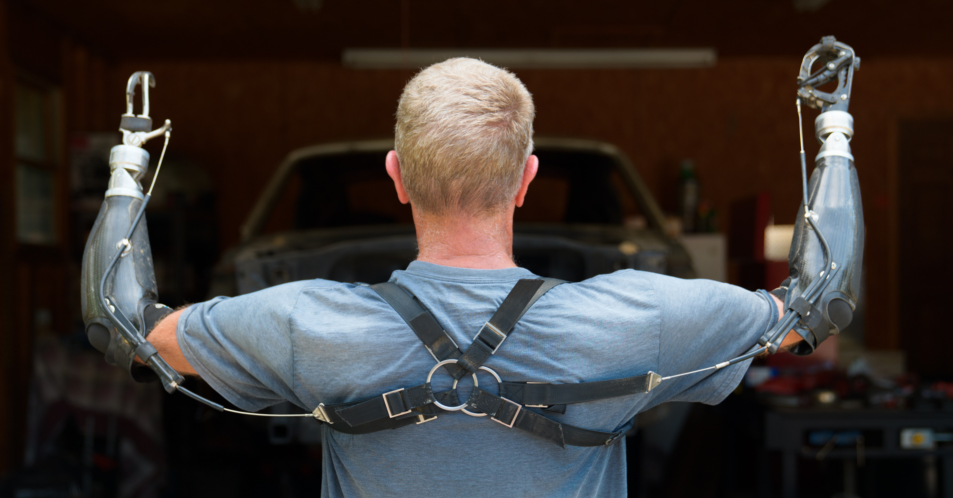 Harnesses and Upper Limb Prostheses