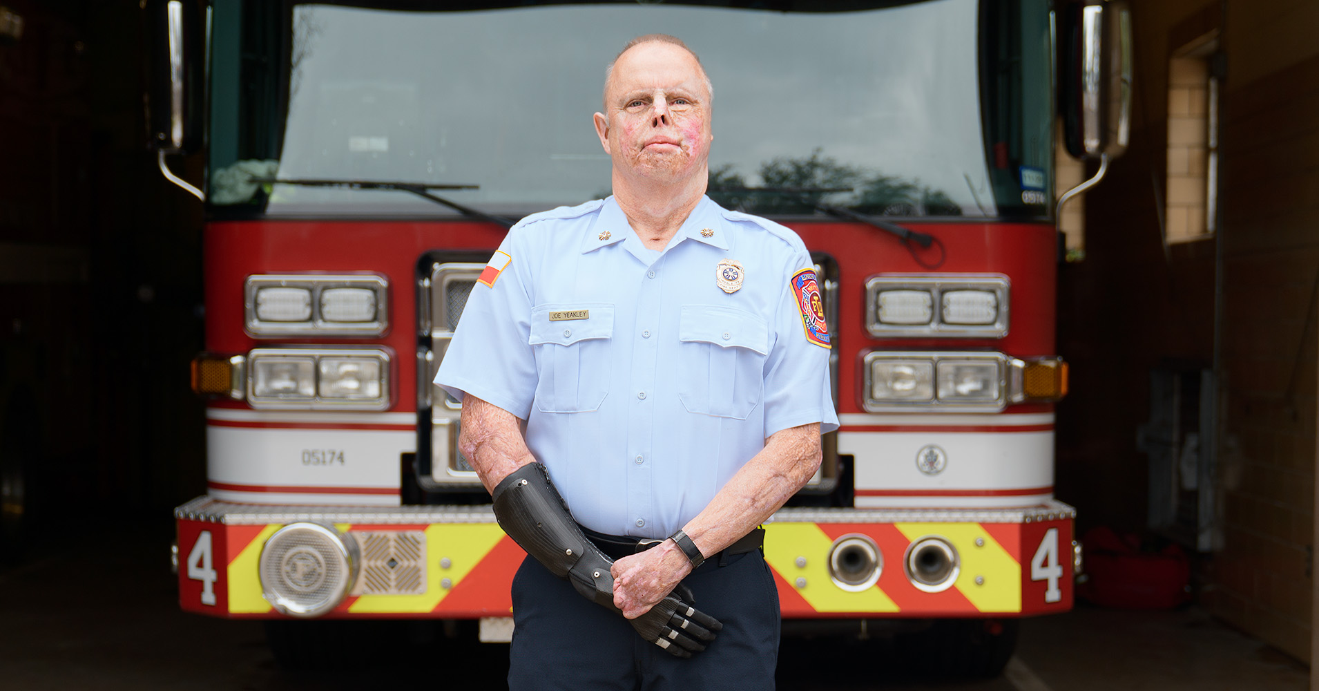 The Evolution of an Upper Limb Prosthetic User: Joe’s Journey