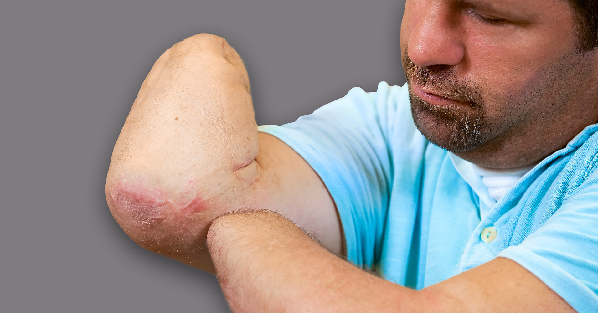 Introduction to Neuromas in Amputated Upper Limbs