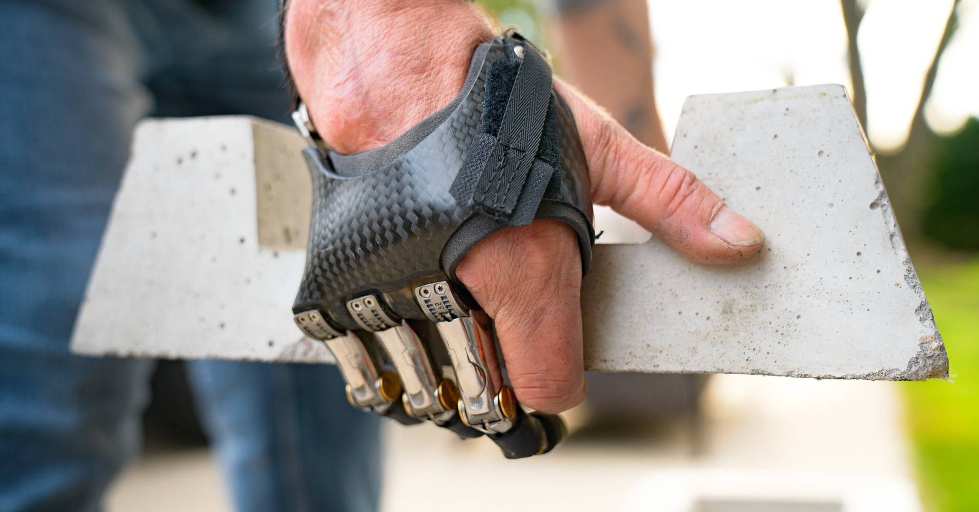 Losing All or Part of My Dominant Hand: Upper Limb Prosthetic Care