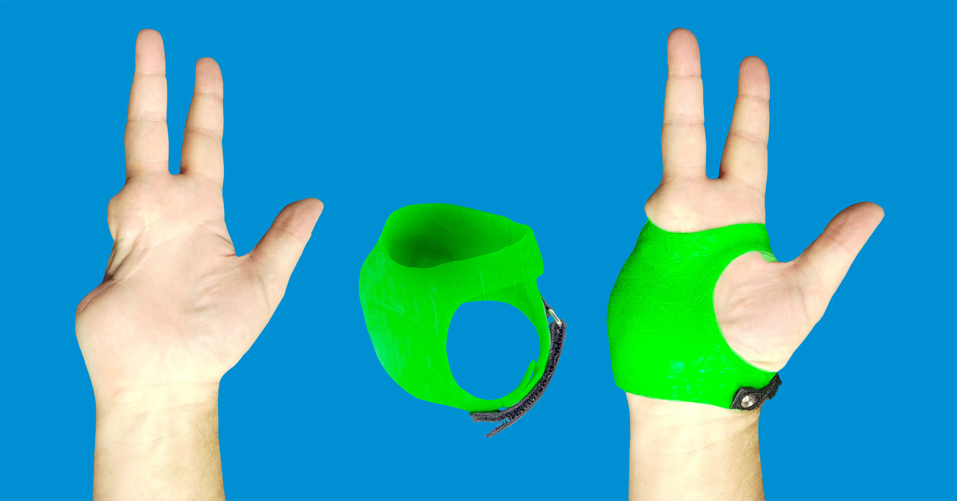 Upper Limb Prostheses: Function and Protection